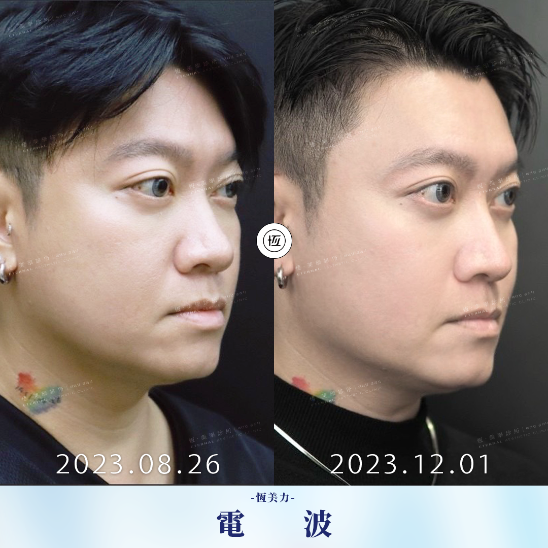 10 THERMA 十蓓電波 | 韓國單極電波天花板 時光停留倍感緊緻 | 恆美學